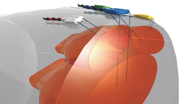 Intramuscolar Needle Electrodes - Spes Medica